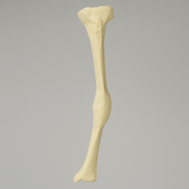 Tibia with Midshaft Malunion and 10º Varus Defect - Sawbones