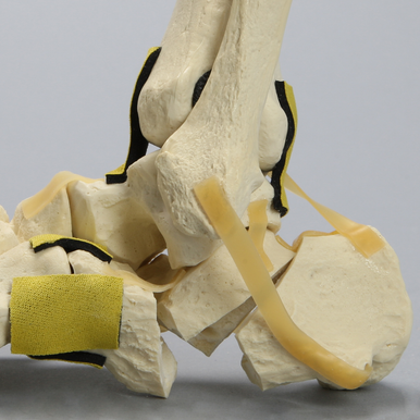 Foot and Ankle with Three-Part Calcaneal Fracture - Sawbones