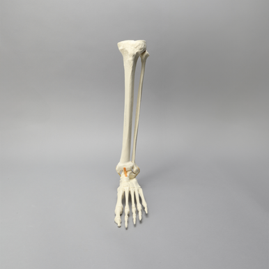 Foot and Ankle with Malunion and Valgus Deformity - Sawbones