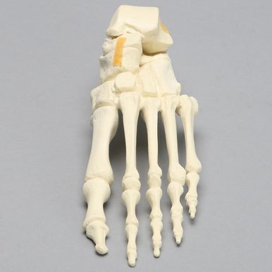 Foot includes a two-part fracture of the talus reattached with latex ...