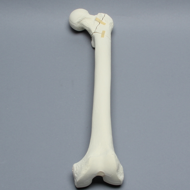 Femur with Intertrochanteric Three-Part Fracture - Sawbones