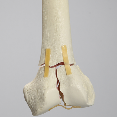 Femur with "T" Fracture - Sawbones