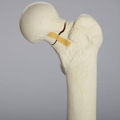 Femur with Neck Fracture - Sawbones