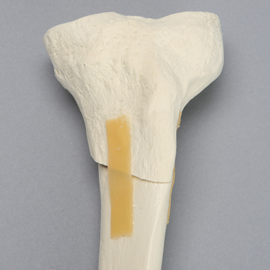 Tibia with Oblique Fracture and Hollow Core - Sawbones