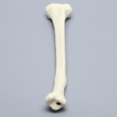 Tibia with Distal Malunion and 25 Degree Varus Defect, Foam Cortical ...
