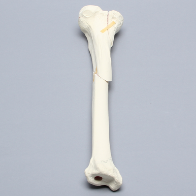 Tibia with Condylar and Oblique Fractures - Sawbones