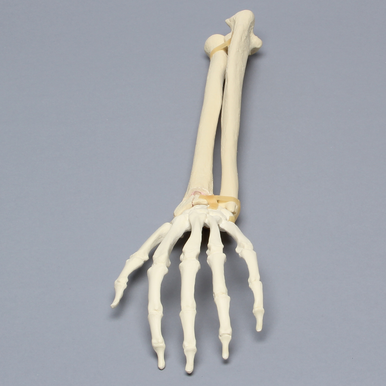 Hand and Wrist with Transverse Radial Fracture, Solid Foam - Sawbones